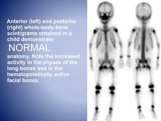 Introduction to Bone Scan: Techniques and Diagnosis | PPTX