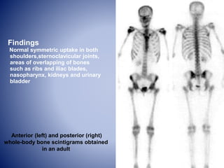 Introduction to Bone Scan: Techniques and Diagnosis | PPT