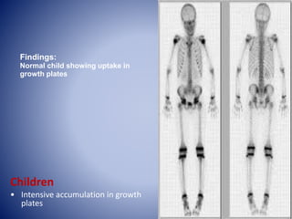 Introduction to Bone Scan: Techniques and Diagnosis | PPT