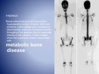 Introduction to Bone Scan: Techniques and Diagnosis | PPT