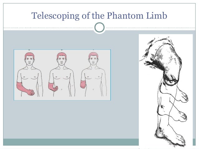 Intro to phantom limb pain