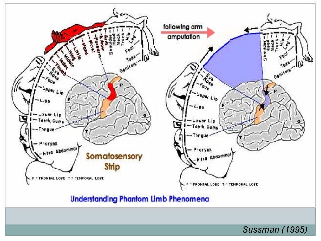 Intro to phantom limb pain