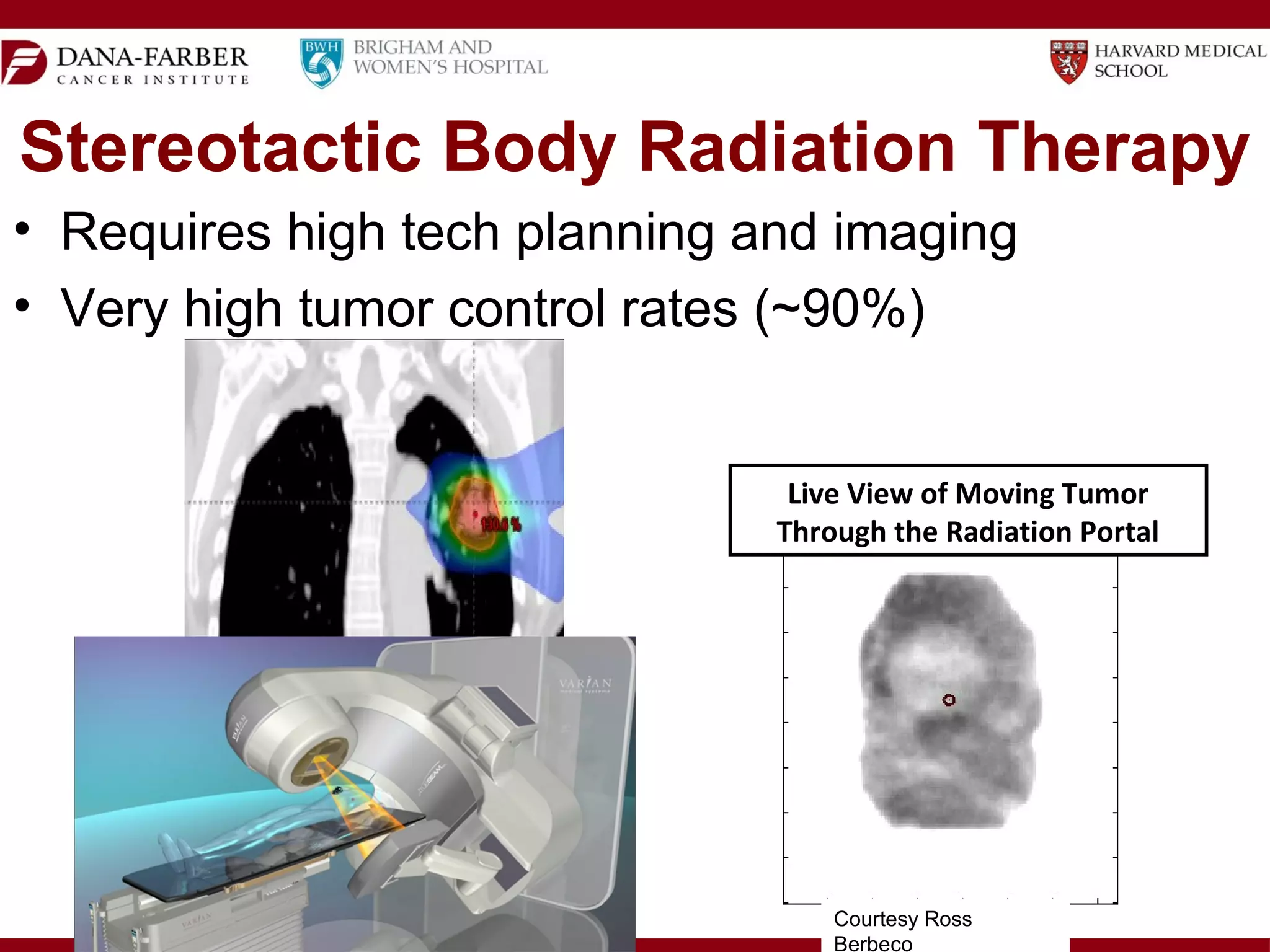 How is Radiation Therapy Used to Help Lung Cancer Patients? | PPT