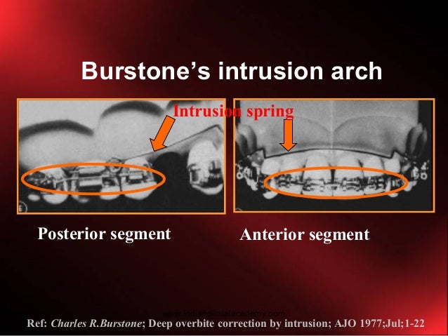 Intrusion in orthodontics /certified fixed orthodontic courses by Ind…
