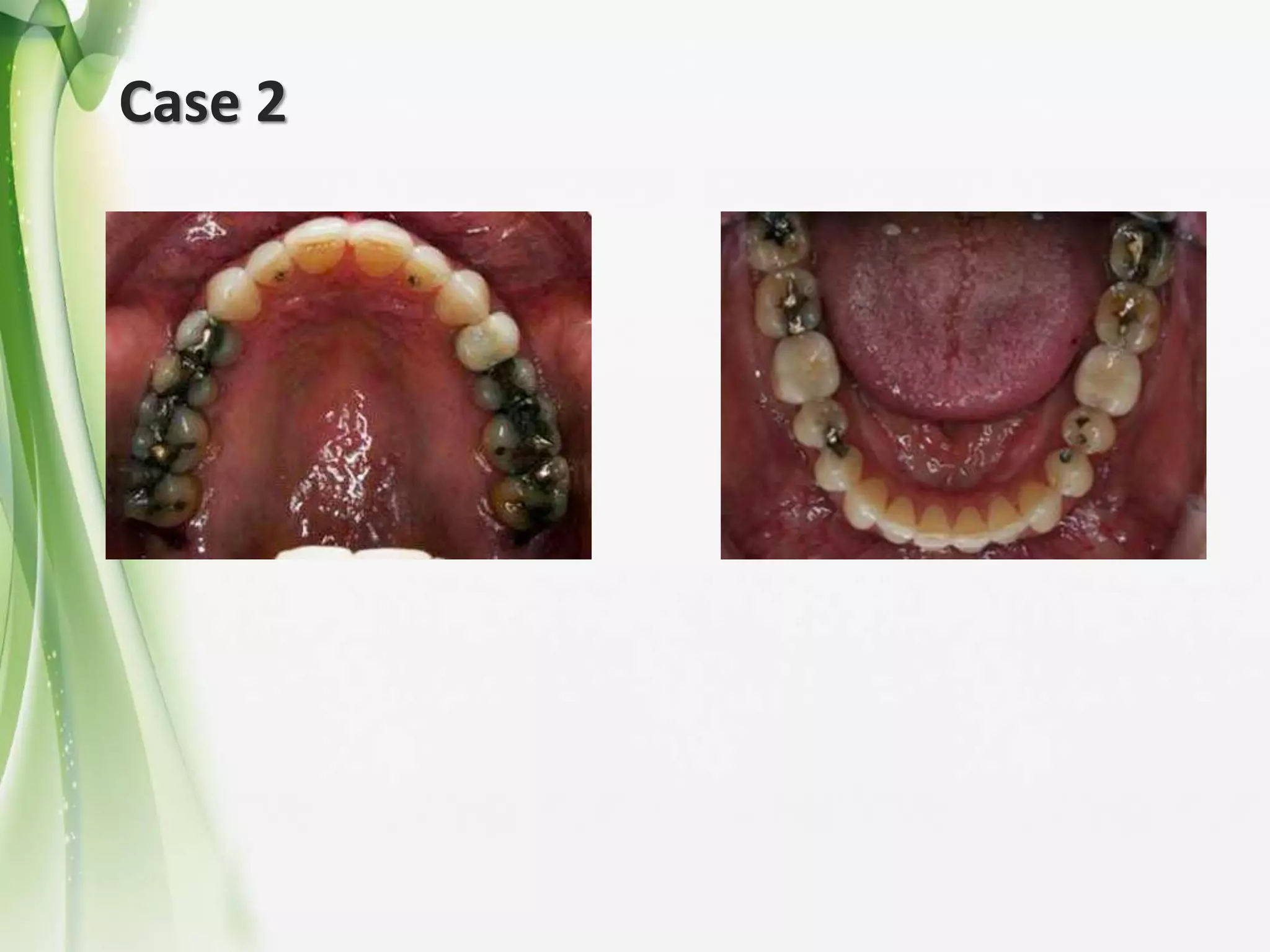 Intrusion and extrusion Invisalign | PPTX