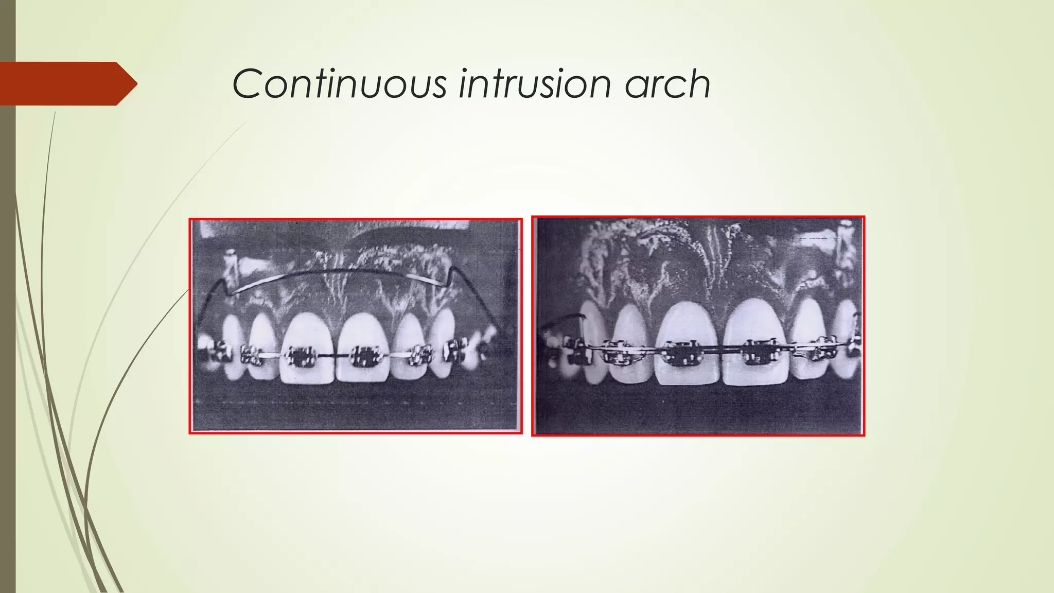 Intrusion arches | PPT