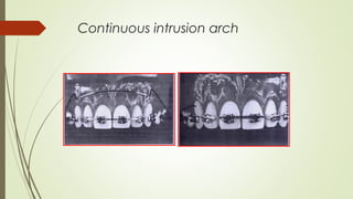 Intrusion arches | PPT