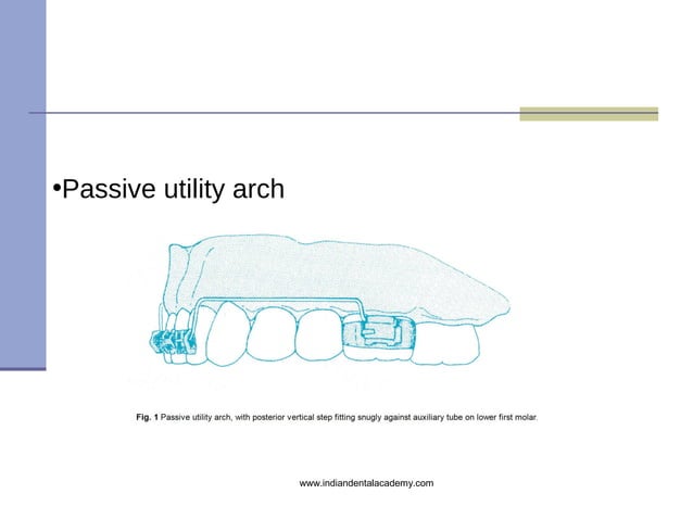 Intrusion arches /certified fixed orthodontic courses by Indian dental ...