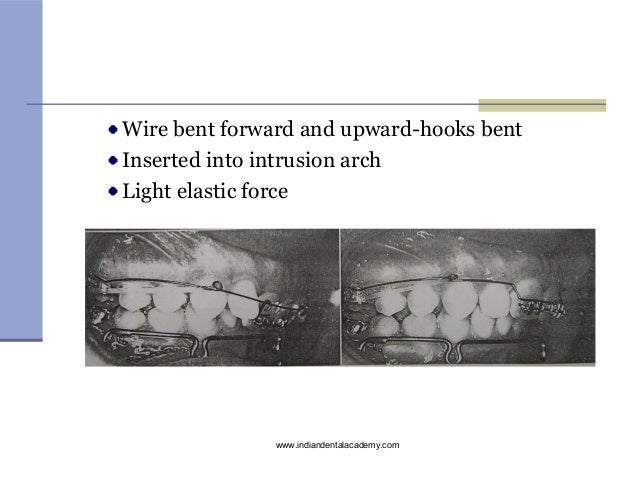 Intrusion arches /certified fixed orthodontic courses by Indian denta…