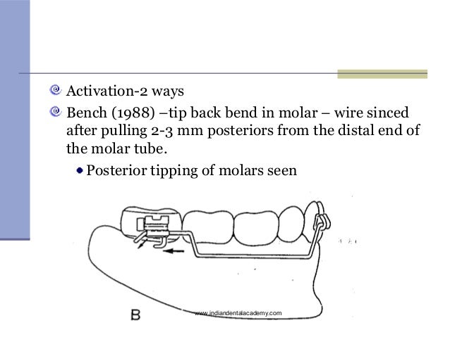 Intrusion arches /certified fixed orthodontic courses by Indian denta…
