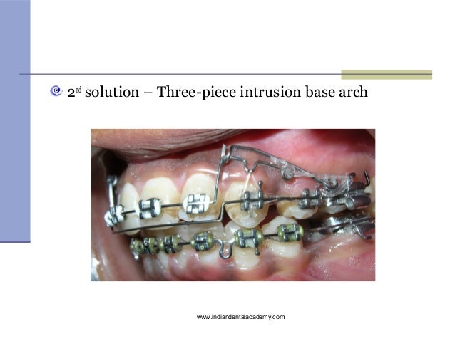 Intrusion arches /certified fixed orthodontic courses by Indian denta…