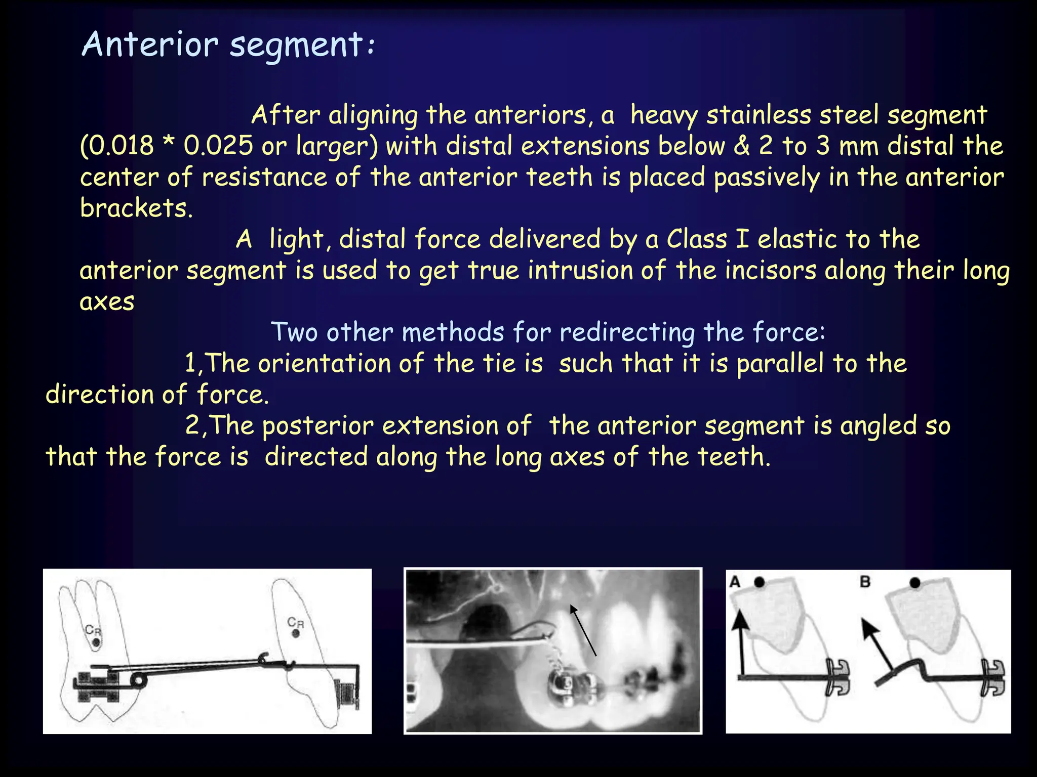 INTRUSION MECHANICS IN ORTHODONTICS..ppt