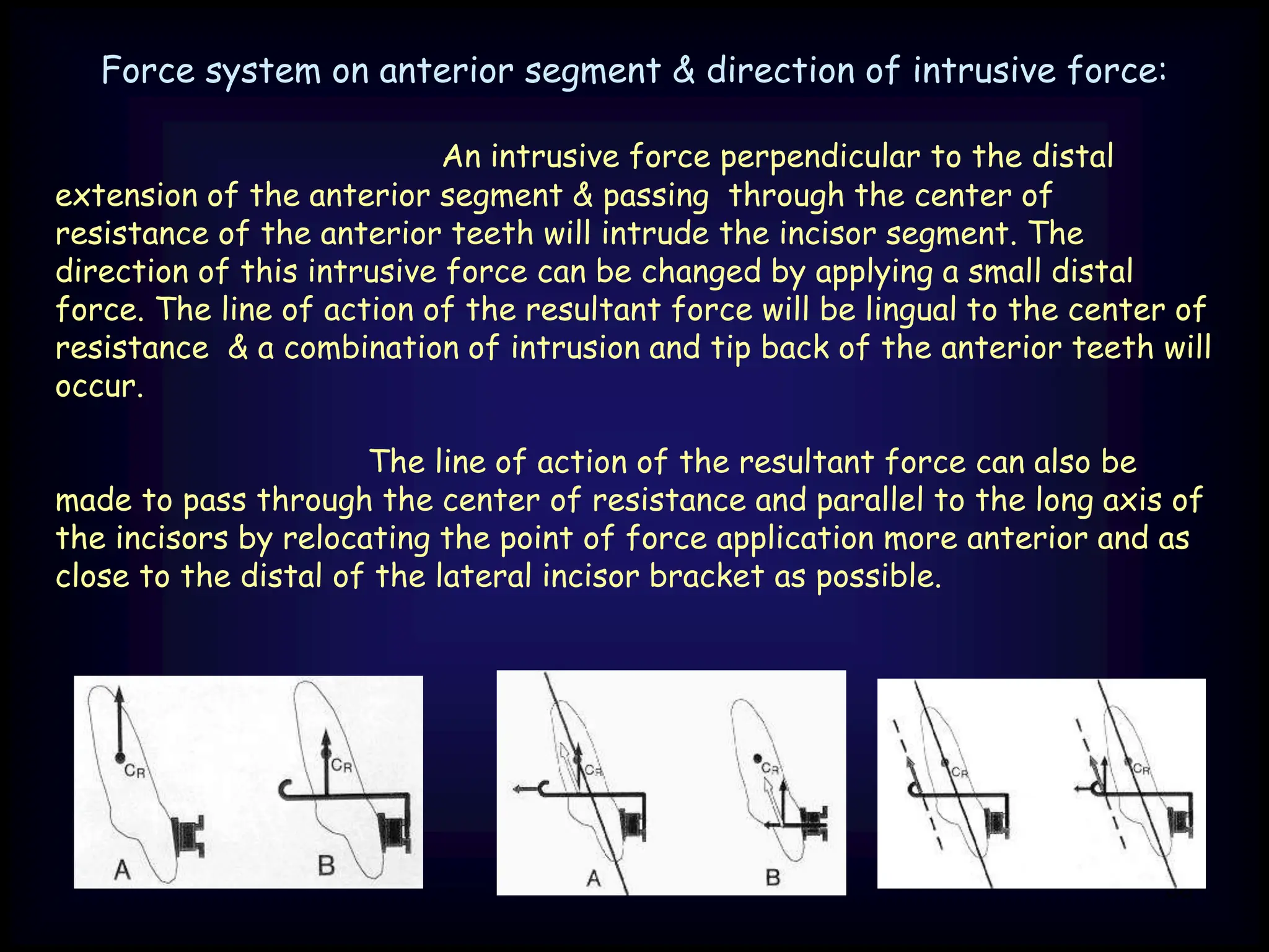 INTRUSION MECHANICS IN ORTHODONTICS..ppt