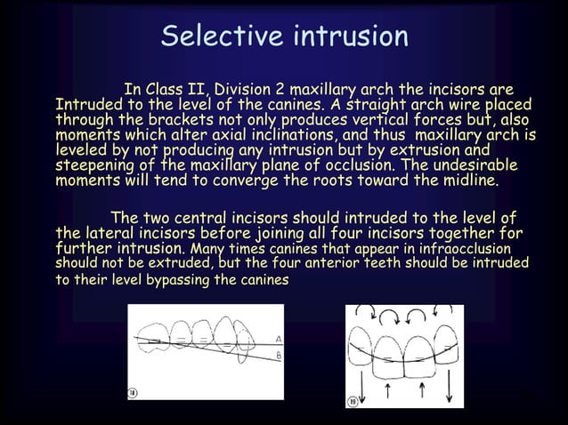 INTRUSION MECHANICS IN ORTHODONTICS..ppt