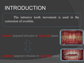 Tooth Intrusion