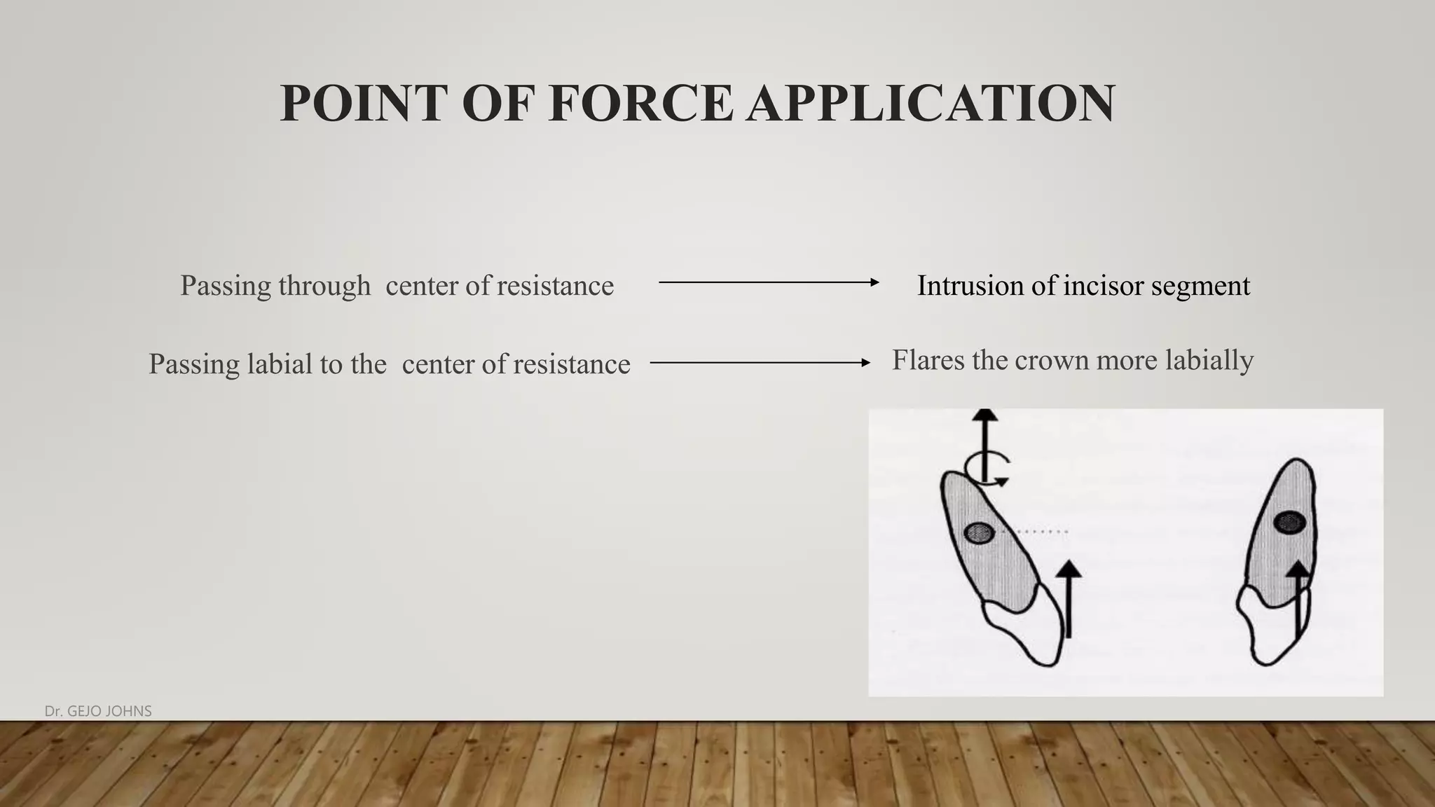 Intrusion mechanics in orthodontics | PPTX