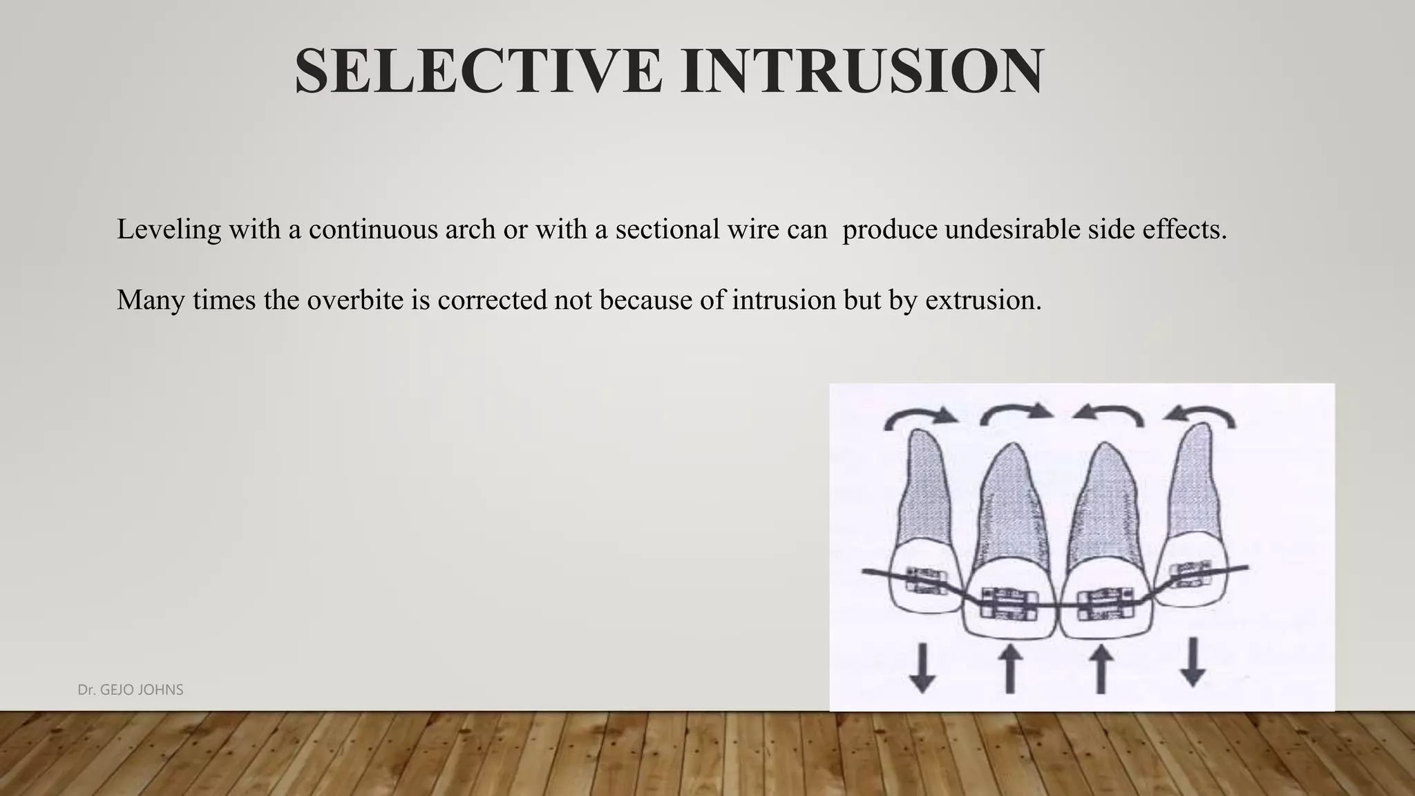 Intrusion mechanics in orthodontics | PPTX