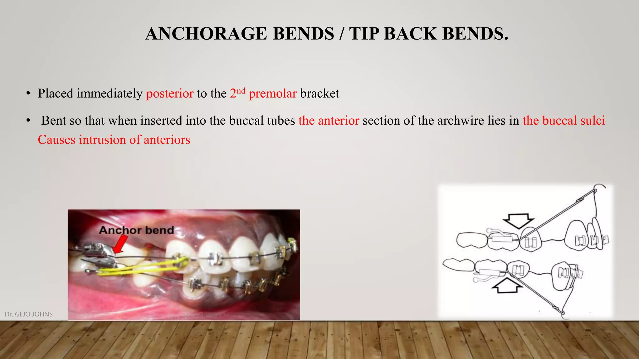 Intrusion mechanics in orthodontics | PPTX