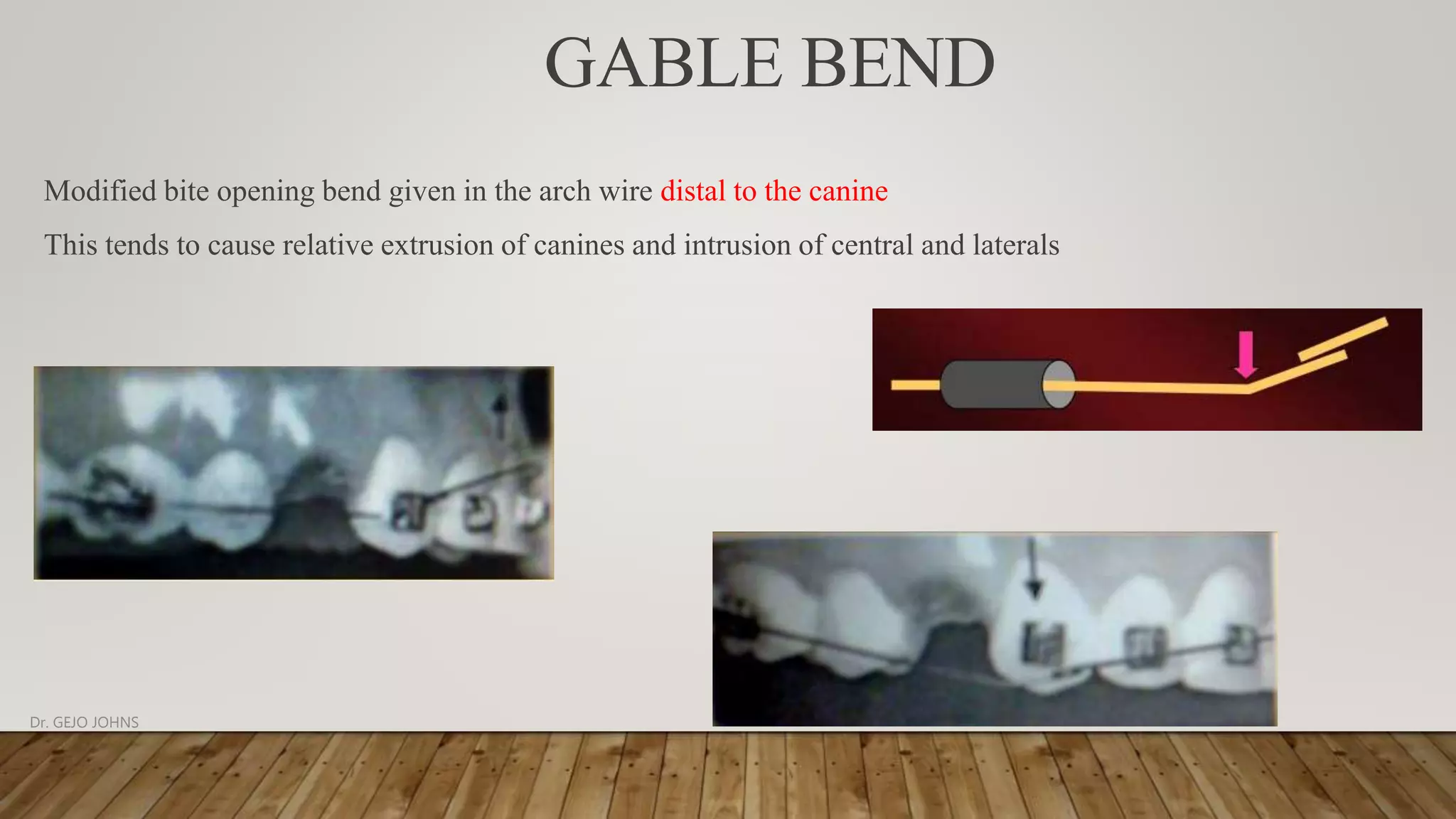Intrusion mechanics in orthodontics | PPTX