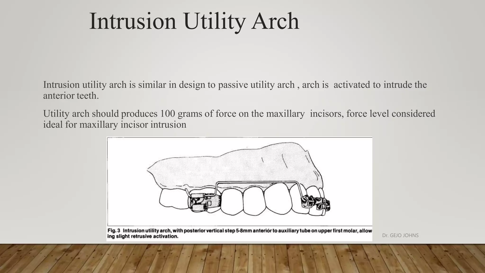 Intrusion mechanics in orthodontics | PPTX