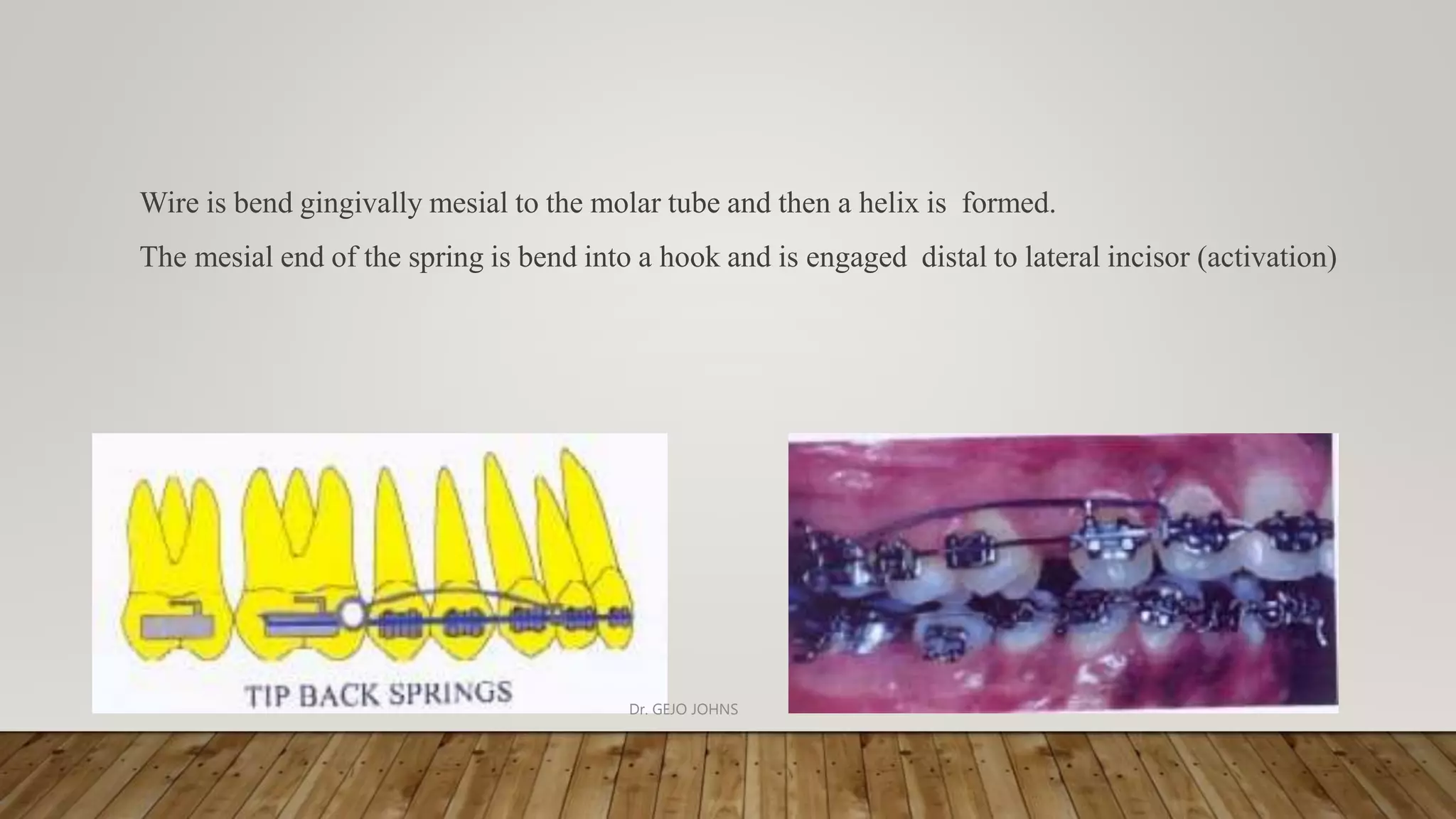 Intrusion mechanics in orthodontics | PPTX