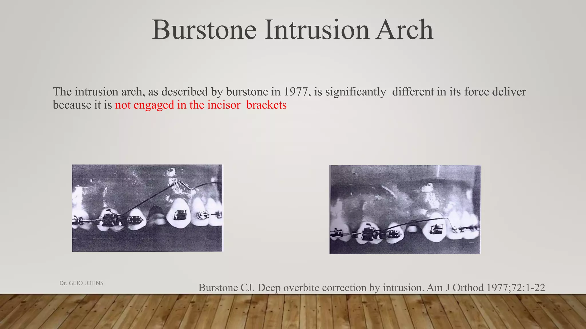 Intrusion mechanics in orthodontics | PPTX