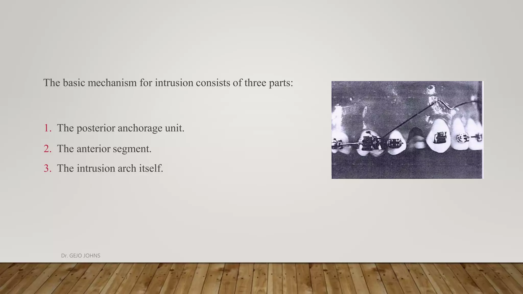 Intrusion mechanics in orthodontics | PPTX