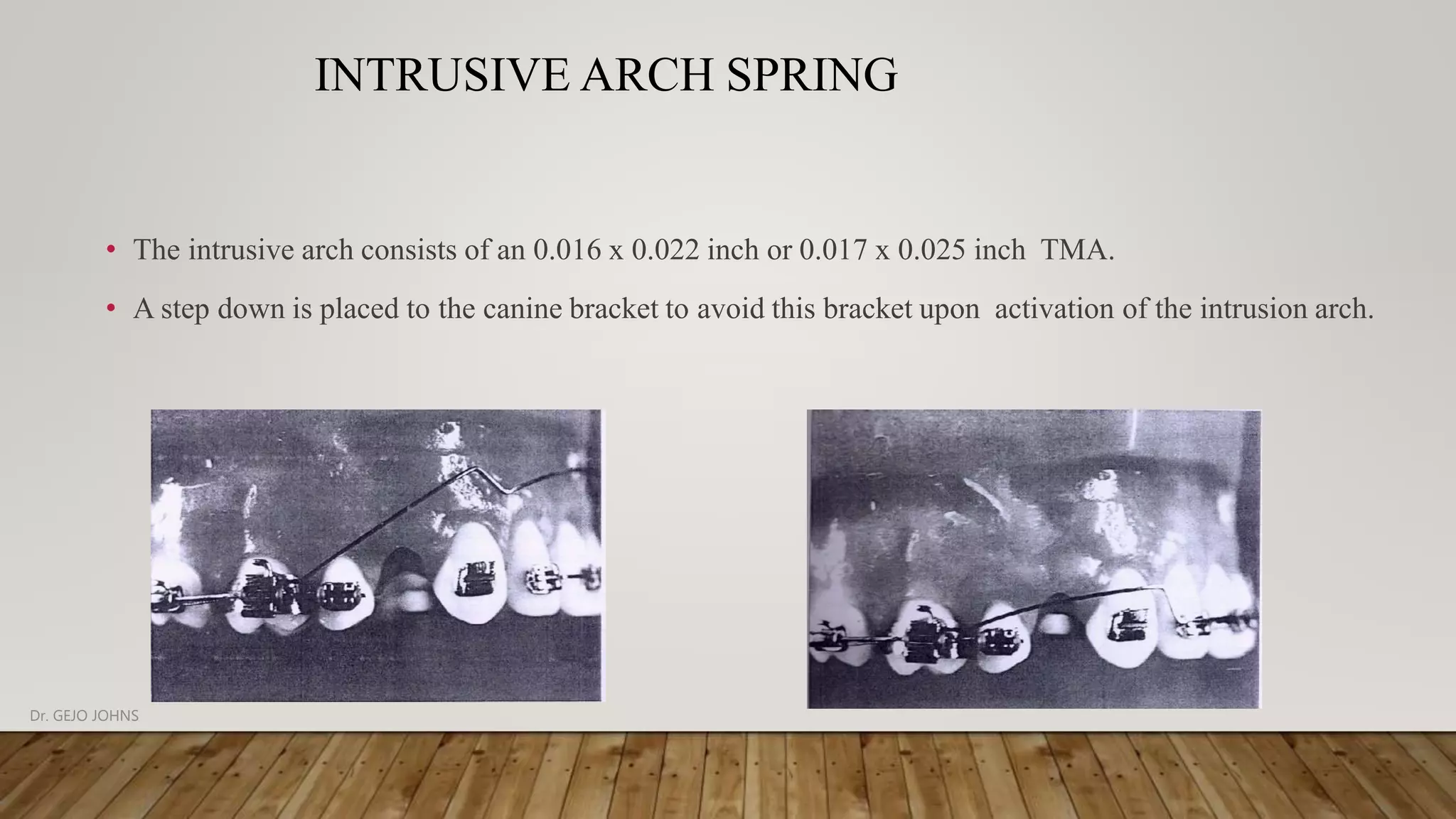 Intrusion mechanics in orthodontics | PPTX