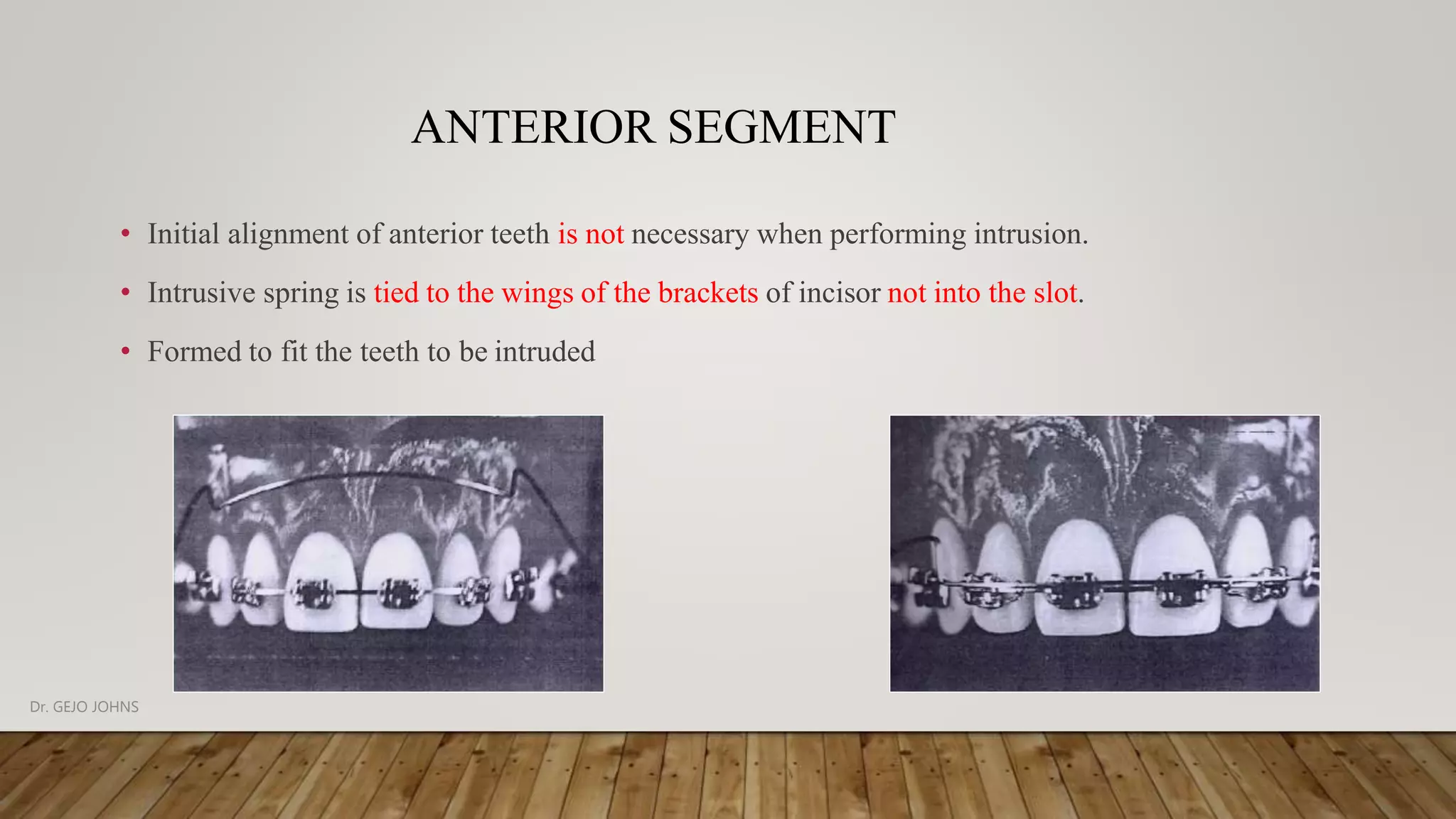 Intrusion mechanics in orthodontics | PPTX