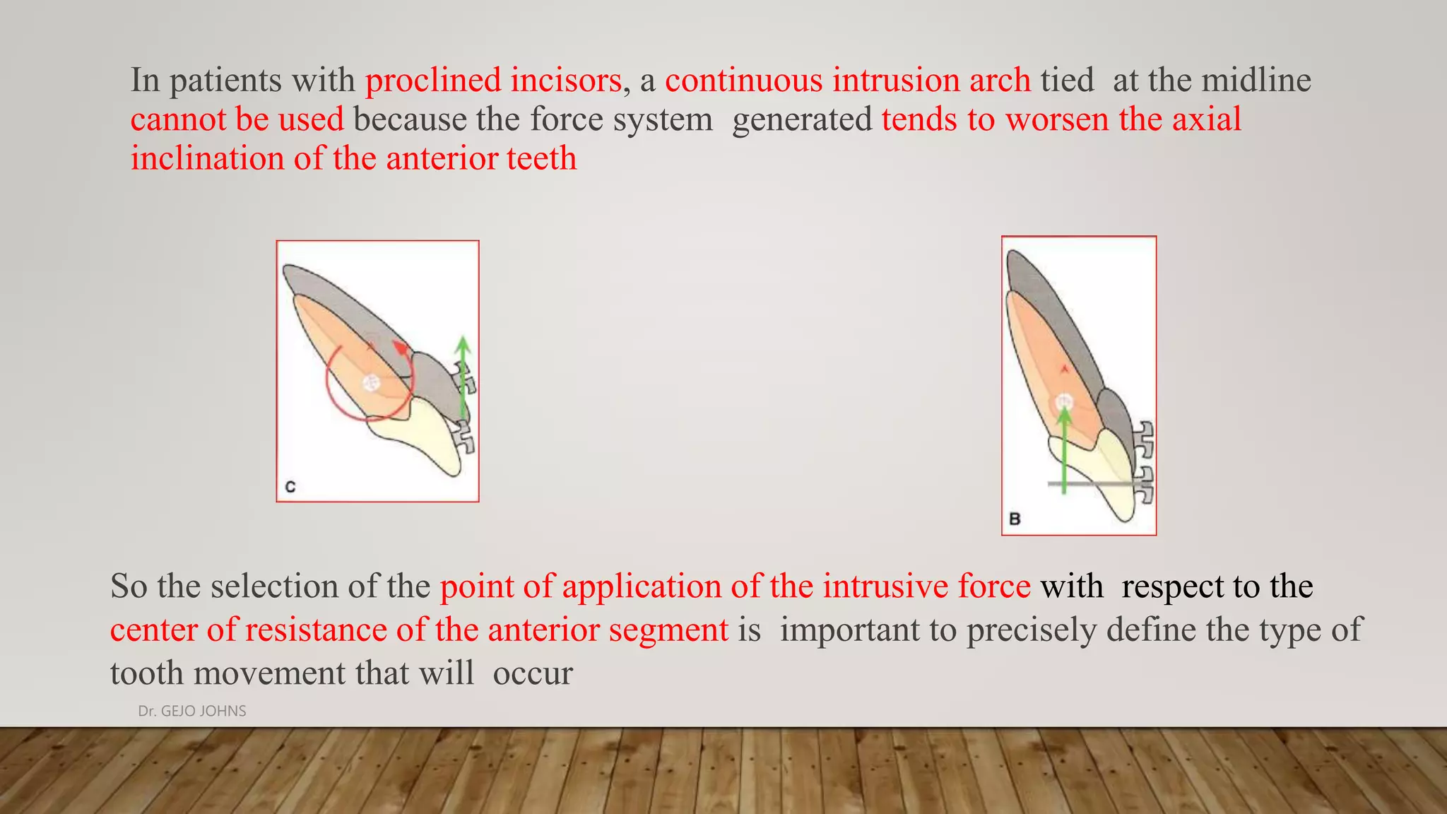 Intrusion mechanics in orthodontics | PPTX