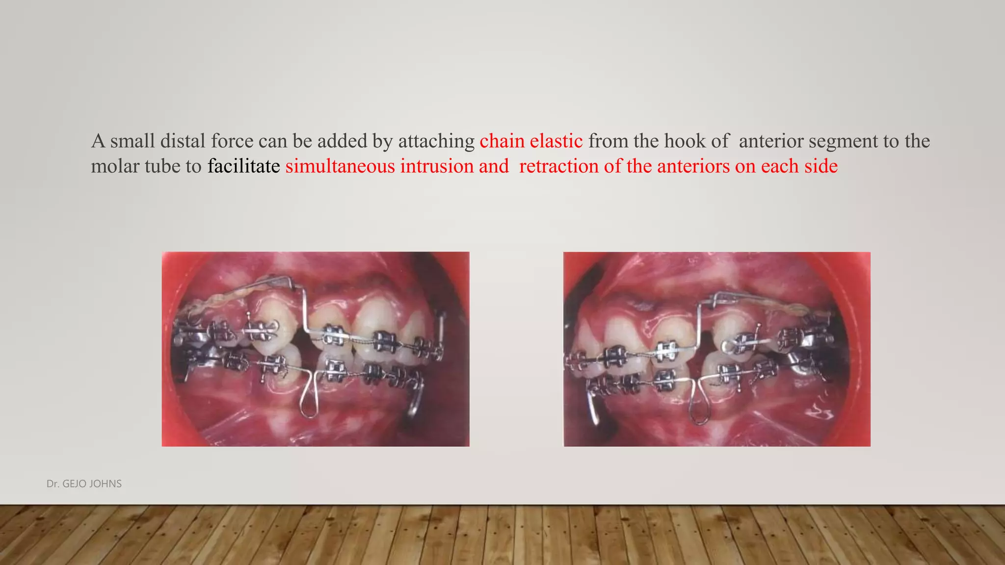 Intrusion mechanics in orthodontics | PPTX