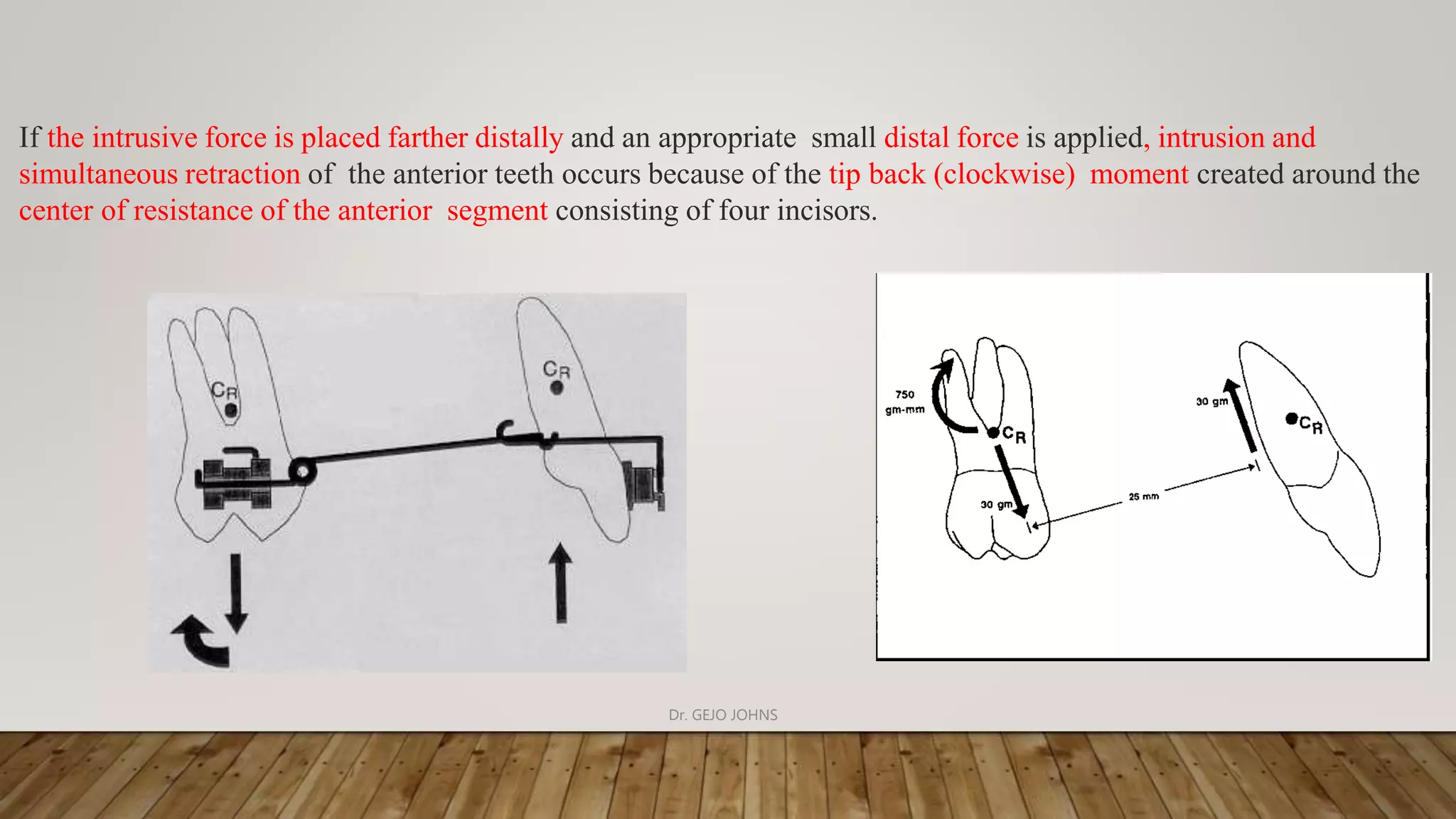 Intrusion mechanics in orthodontics | PPTX