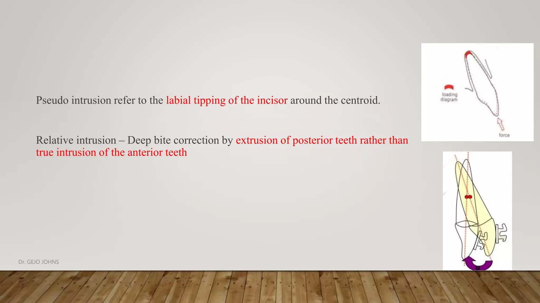 Intrusion mechanics in orthodontics | PPTX