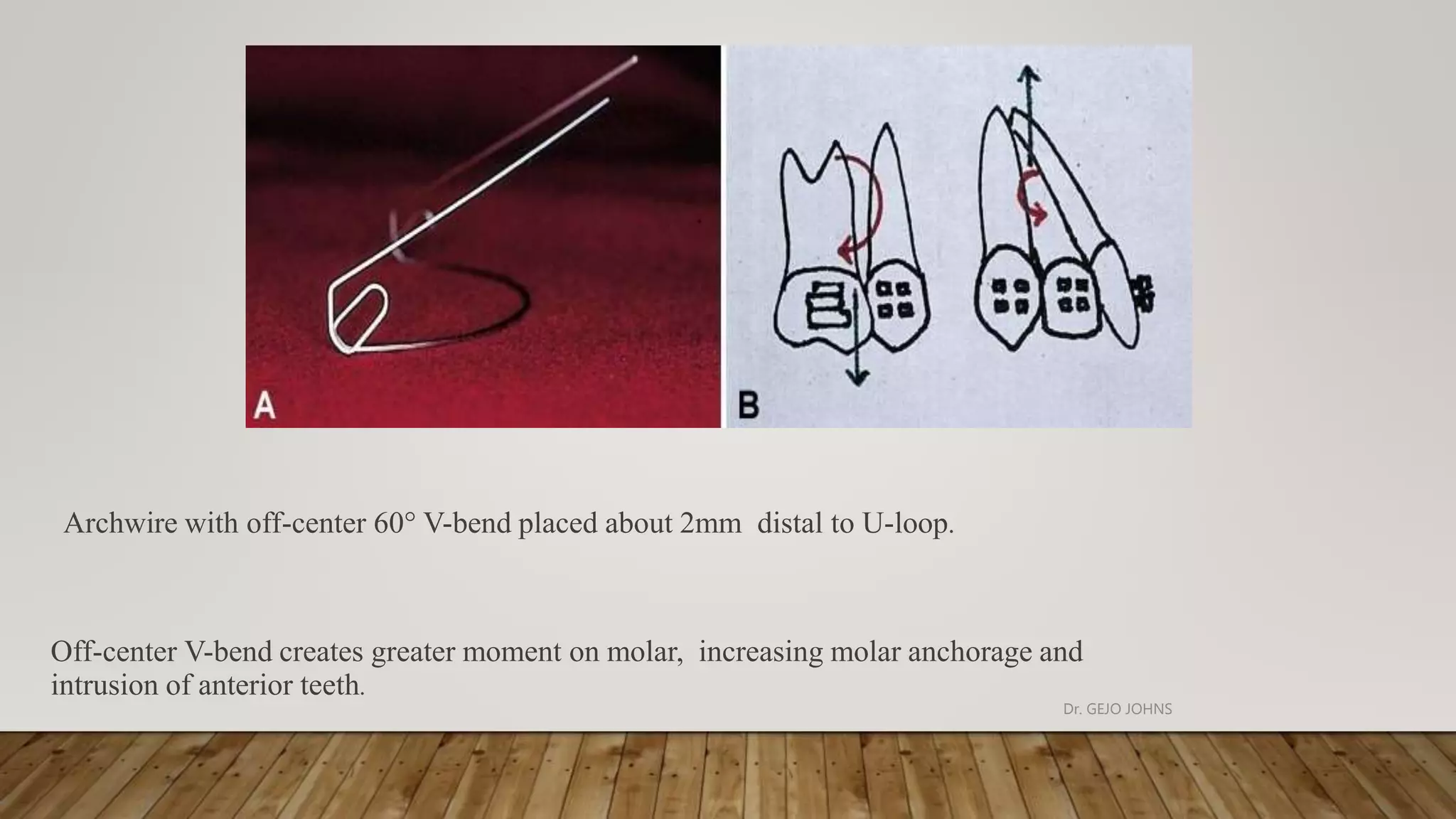 Intrusion mechanics in orthodontics | PPTX