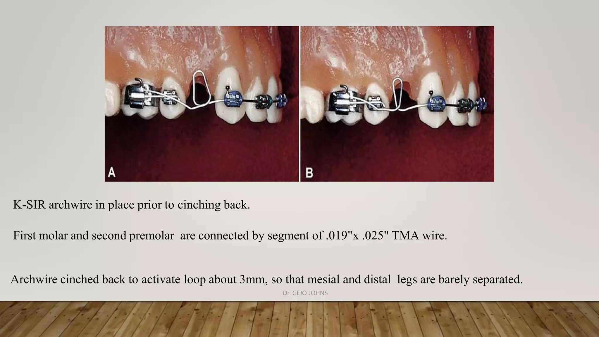Intrusion mechanics in orthodontics | PPTX