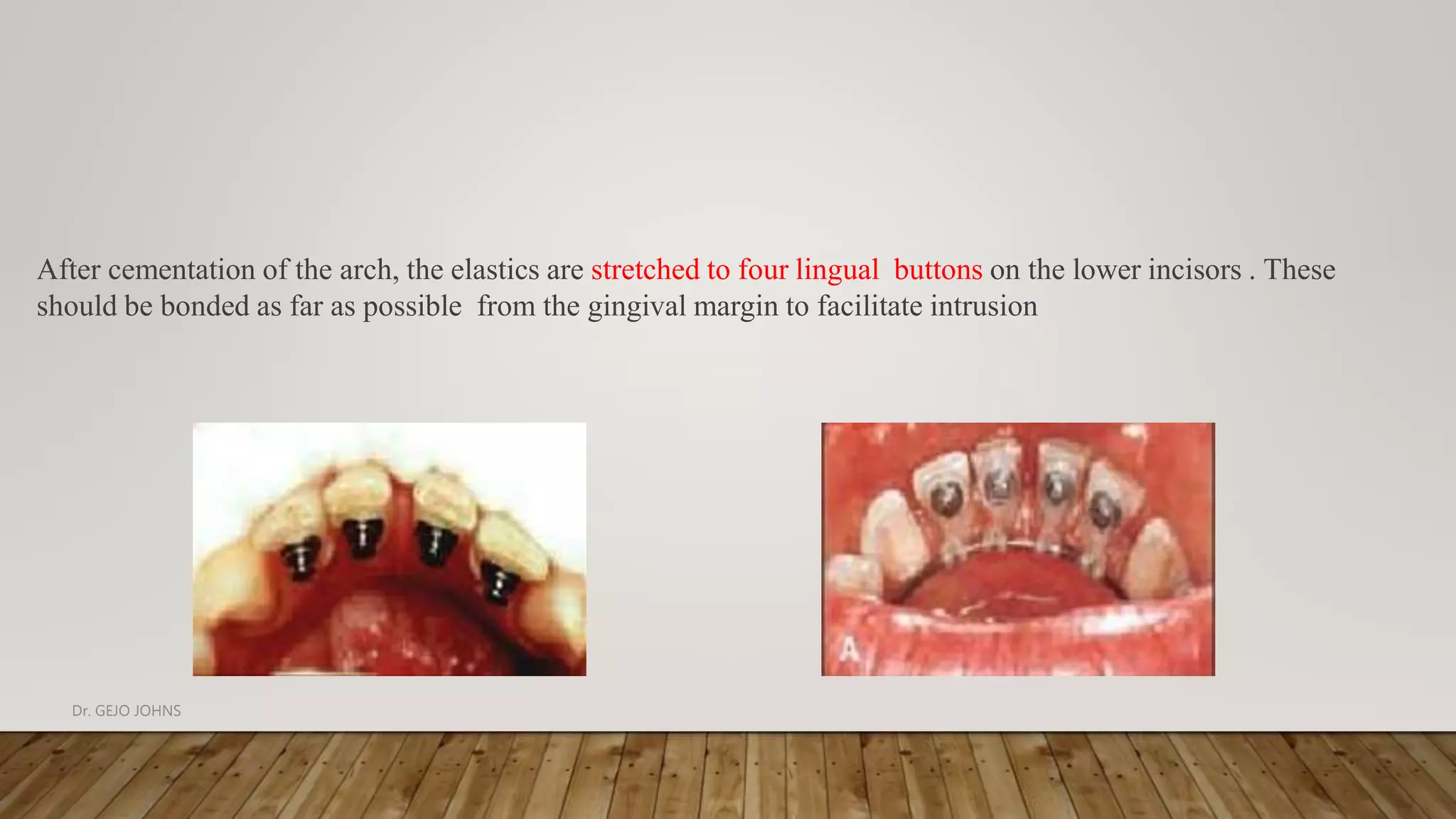 Intrusion mechanics in orthodontics | PPTX