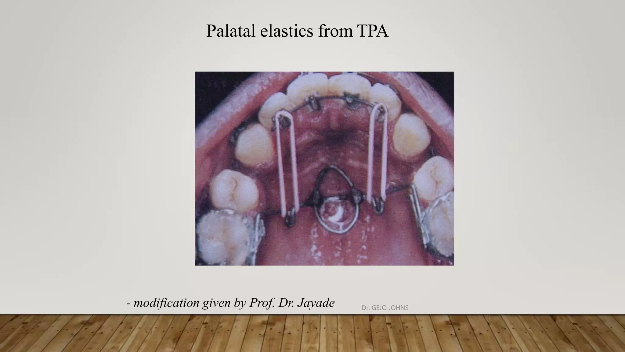 Intrusion mechanics in orthodontics | PPTX