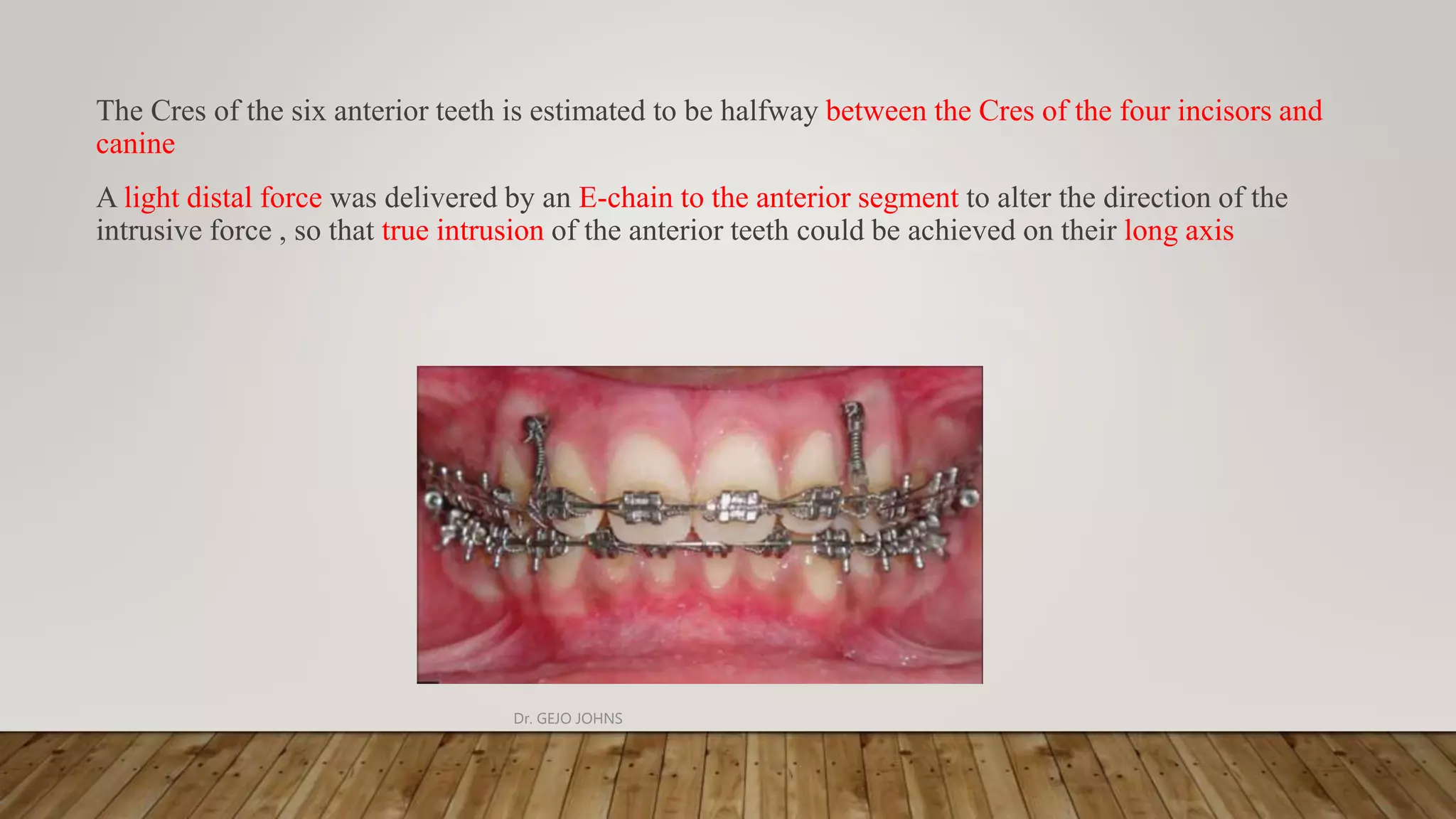 Intrusion mechanics in orthodontics | PPTX
