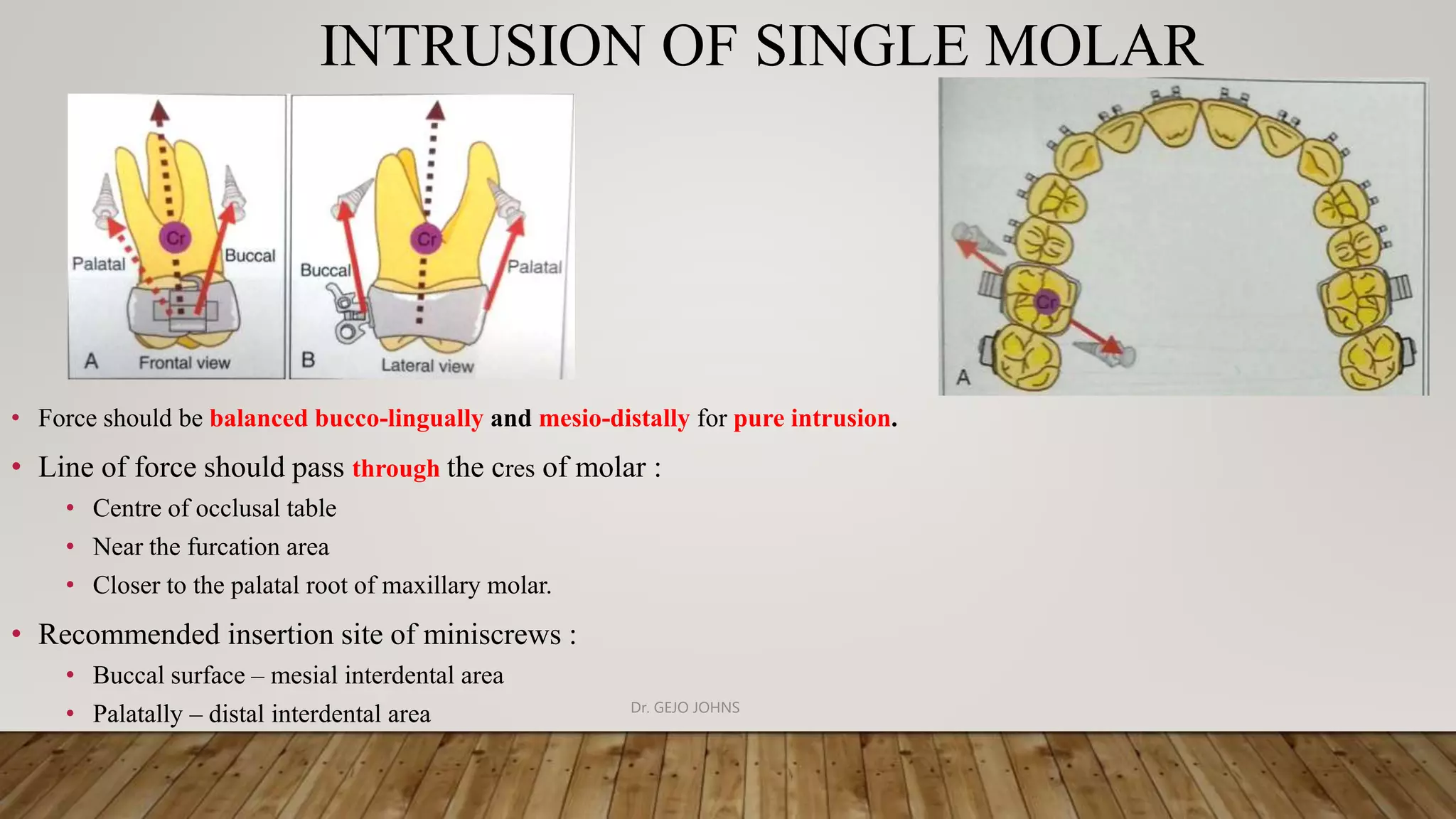Intrusion mechanics in orthodontics | PPTX