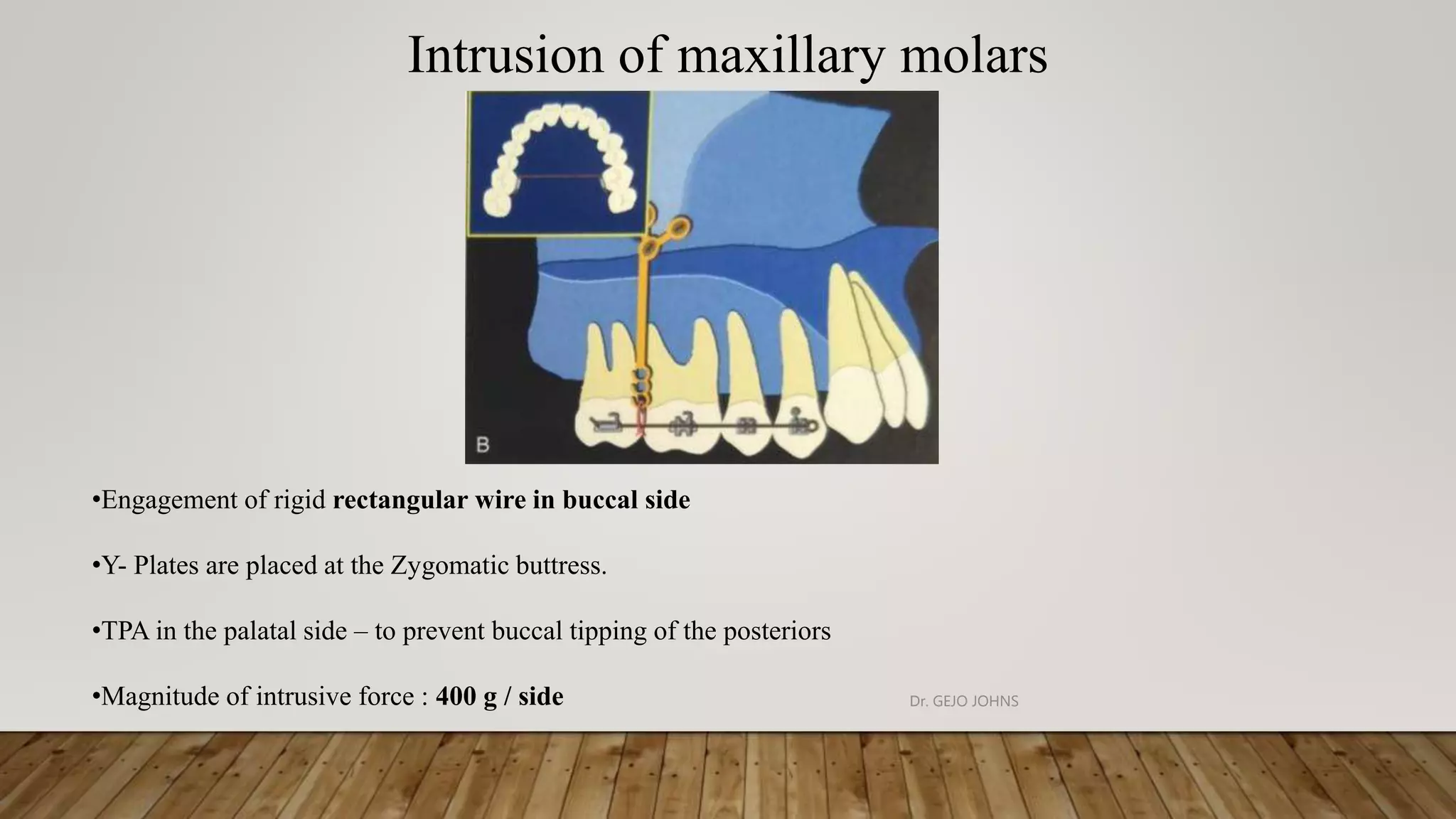 Intrusion mechanics in orthodontics | PPTX
