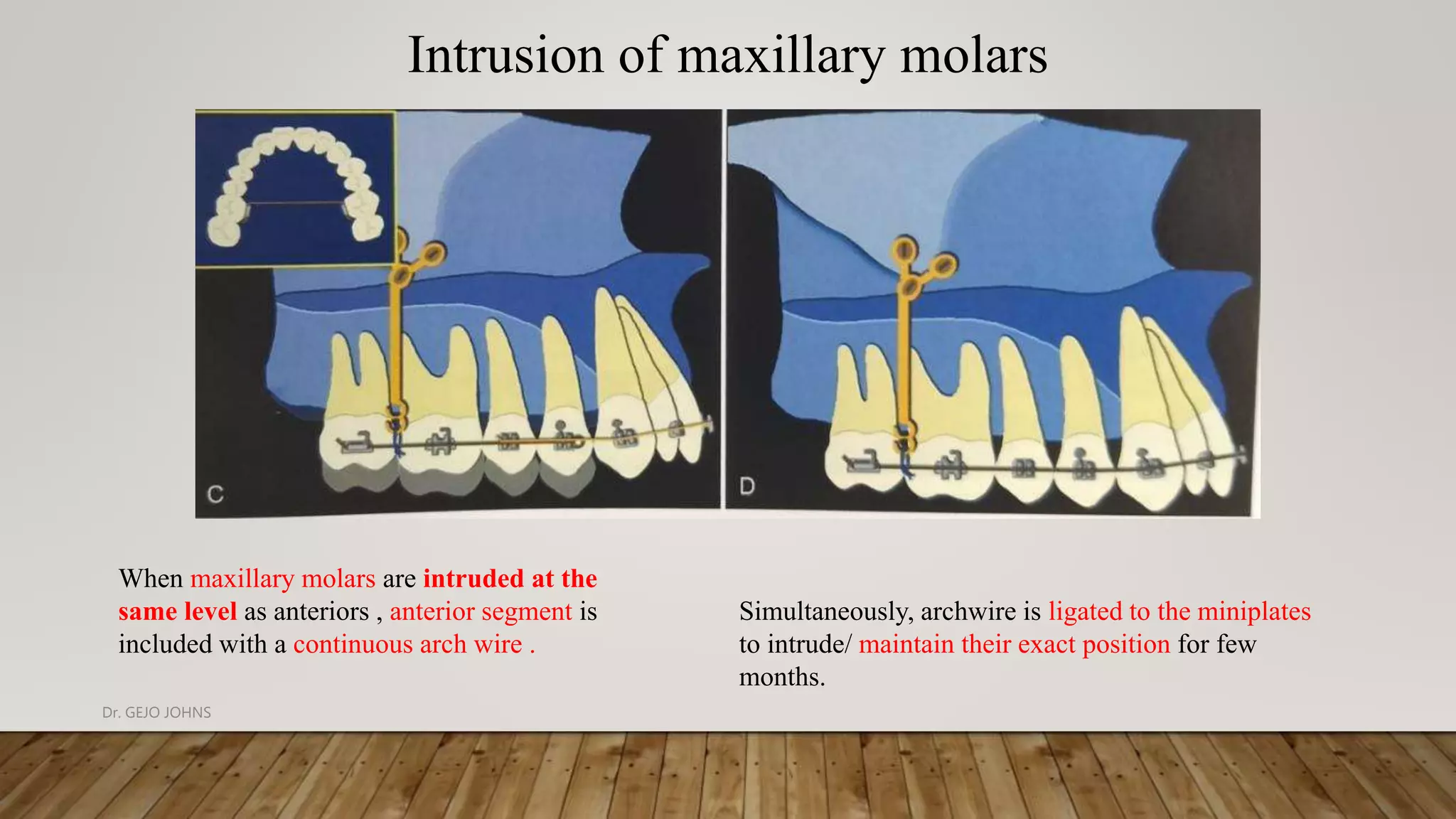 Intrusion mechanics in orthodontics | PPTX