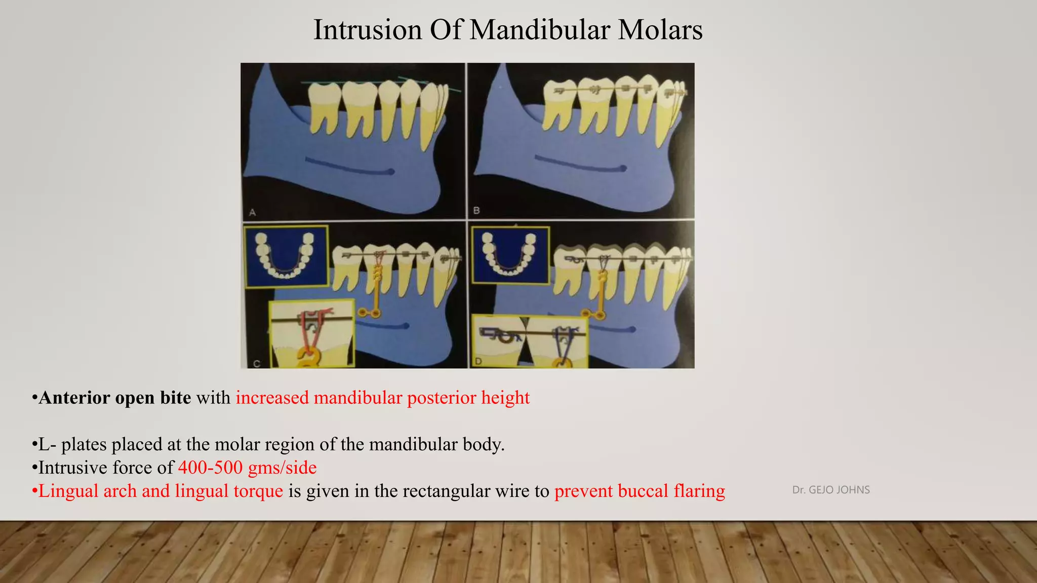 Intrusion mechanics in orthodontics | PPTX