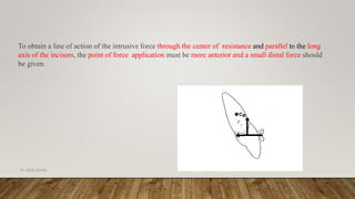 Intrusion mechanics in orthodontics | PPTX