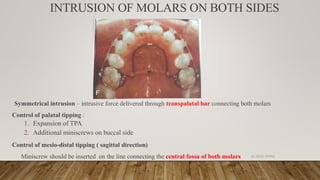 Intrusion mechanics in orthodontics | PPTX