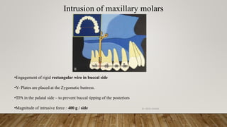 Intrusion mechanics in orthodontics | PPTX