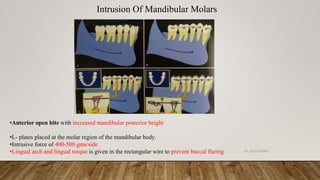 Intrusion mechanics in orthodontics | PPTX
