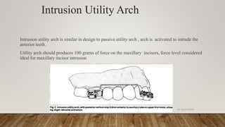 Intrusion mechanics in orthodontics | PPT