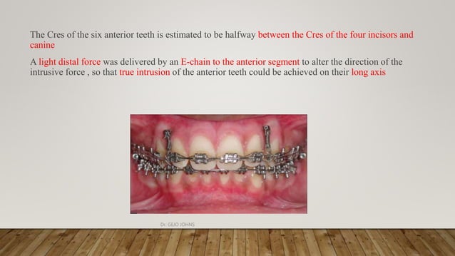 Intrusion mechanics in orthodontics | PPT