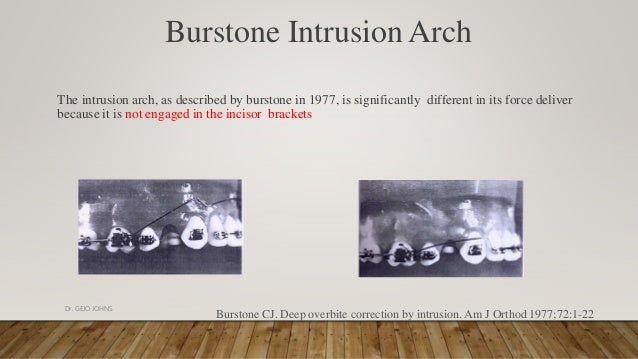 Intrusion mechanics in orthodontics