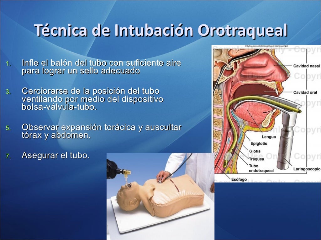 Intubacion endotraqueal